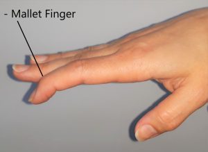 Common Hand Injuries - My Family Physio