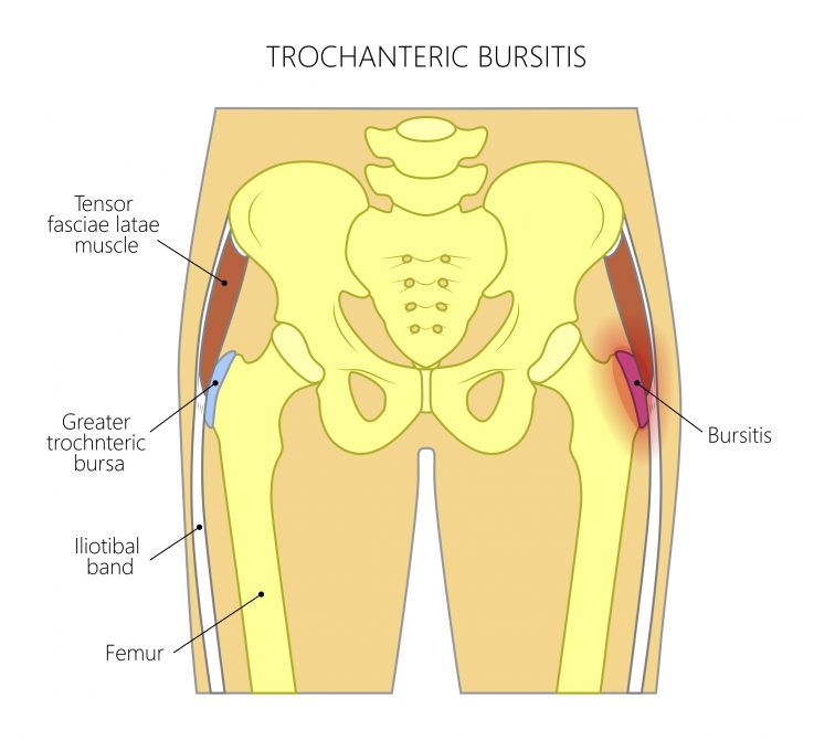 Common Hip Injuries - My Family Physio Common Hip Injuries - My Family Physio