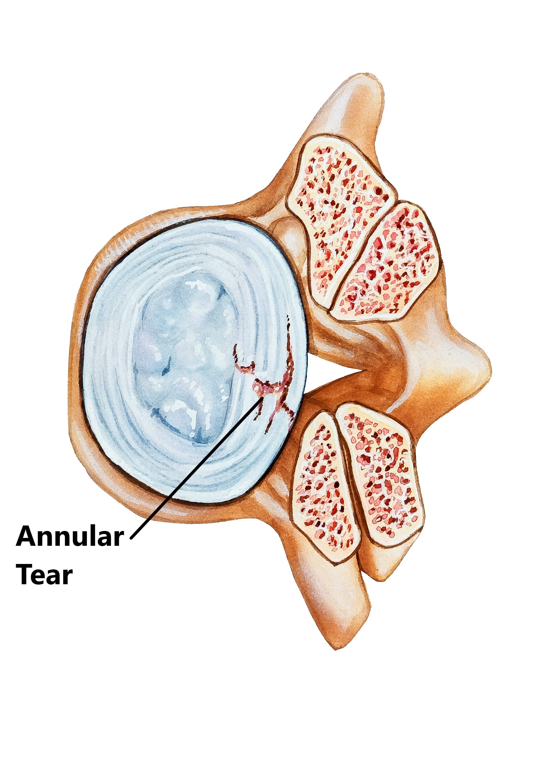 Intervertebral Disc Injuries - My Family Physio