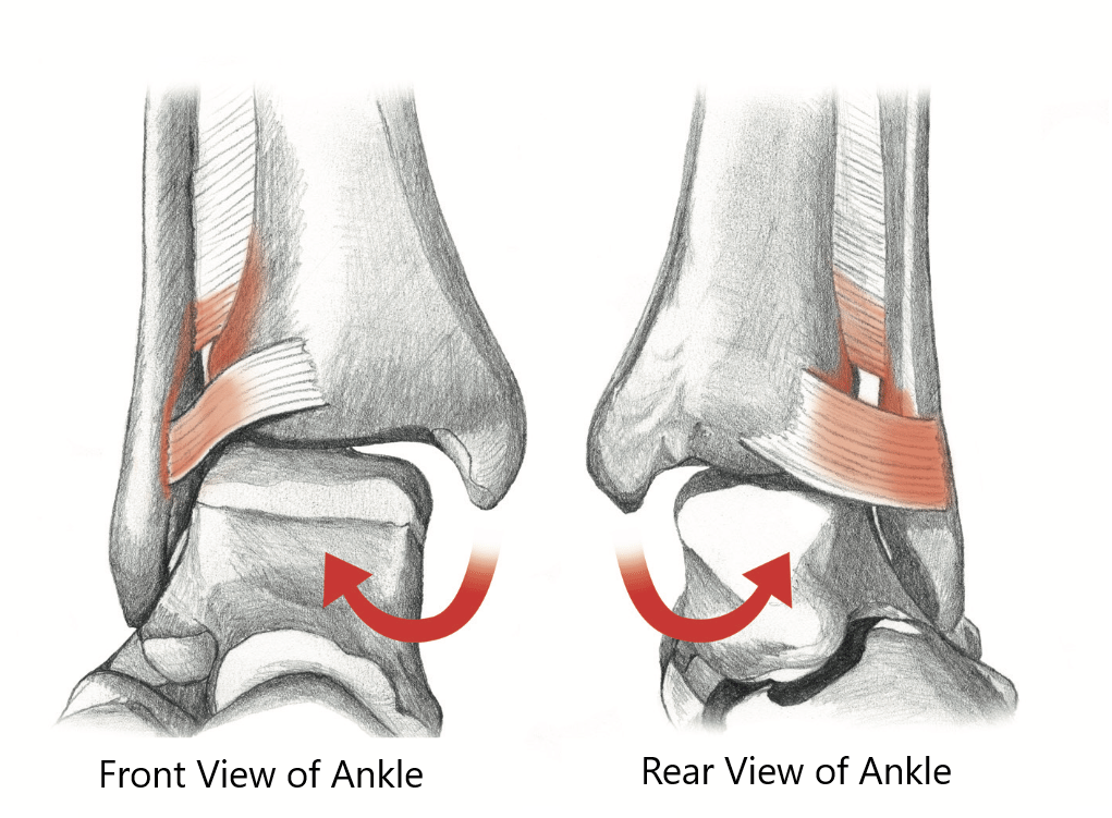 Ankle Sprains - My Family Physio