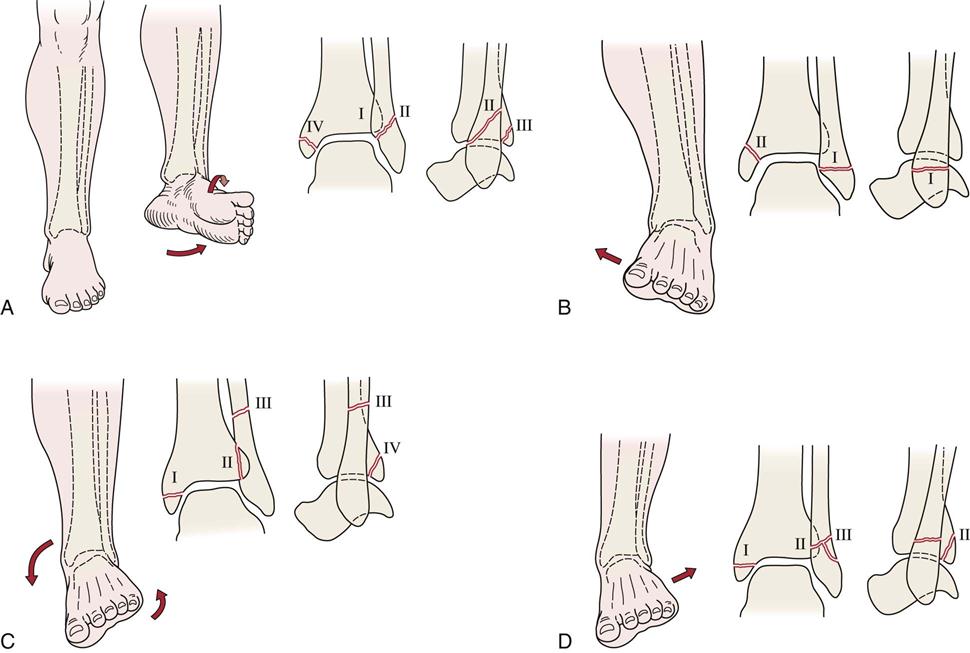 Ankle Sprains - My Family Physio