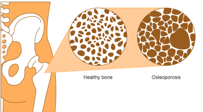 Osteoporosis - My Family Physio
