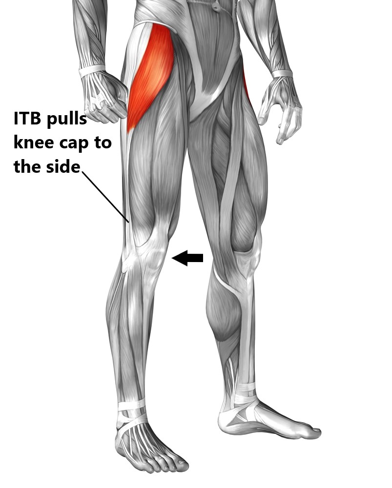 Patellofemoral Pain Syndrome - My Family Physio
