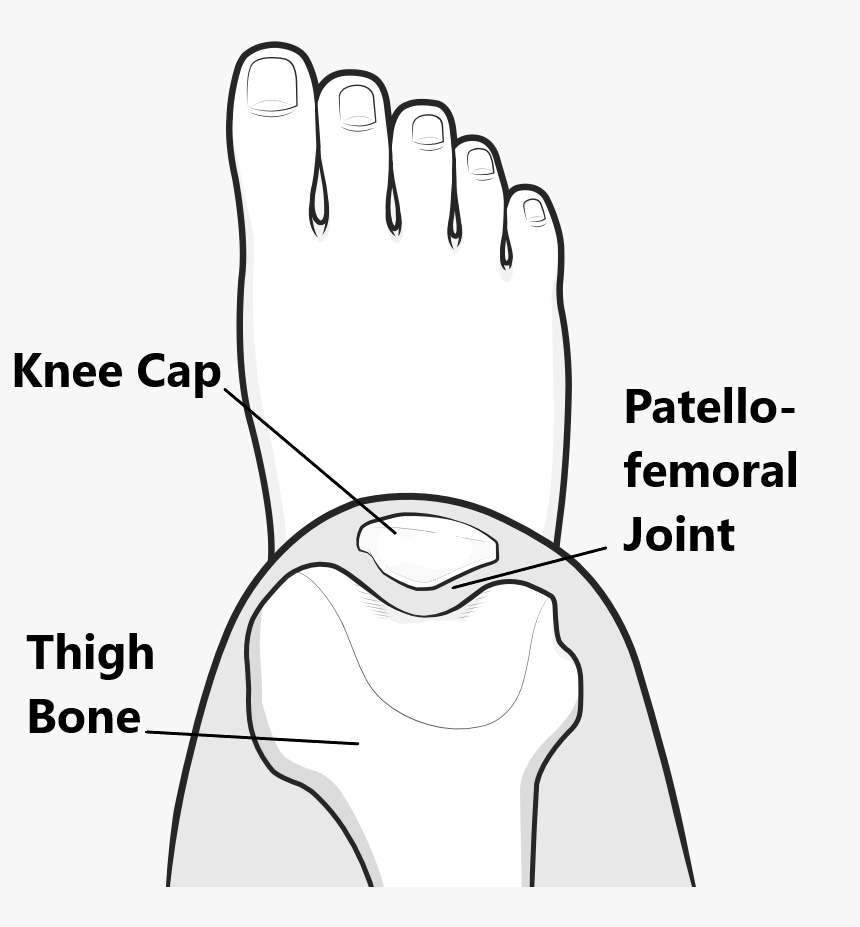 Patellofemoral Pain Syndrome - My Family Physio