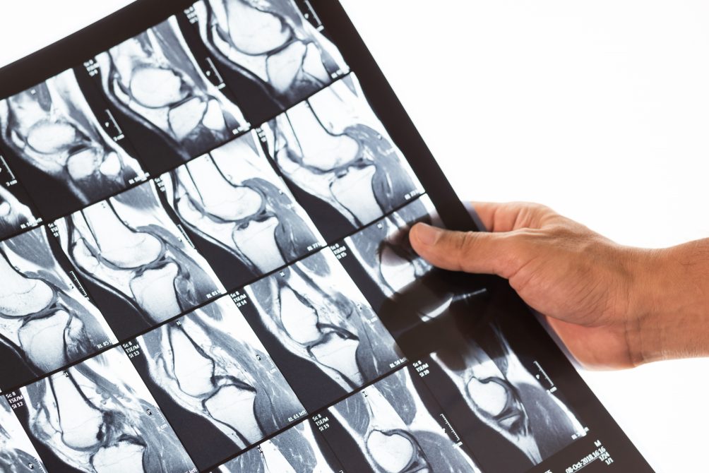 Medial Collateral Ligament (MCL) Injuries - My Family Physio