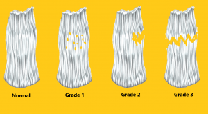 Medial Collateral Ligament (MCL) Injuries - My Family Physio
