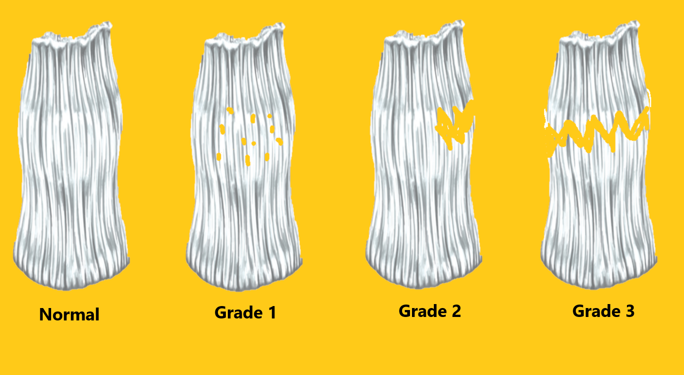 Medial Collateral Ligament (MCL) Injuries - My Family Physio