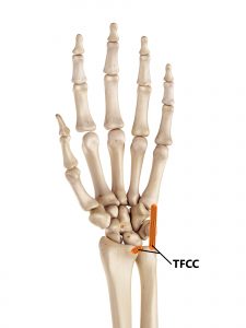 TFCC Injuries - My Family Physio