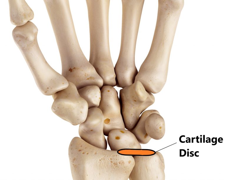 TFCC Injuries - My Family Physio