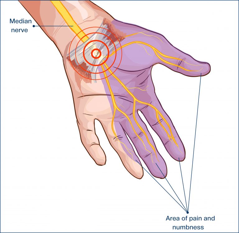 Management of Pins and Needles and Numbness in the Upper Limbs and ...