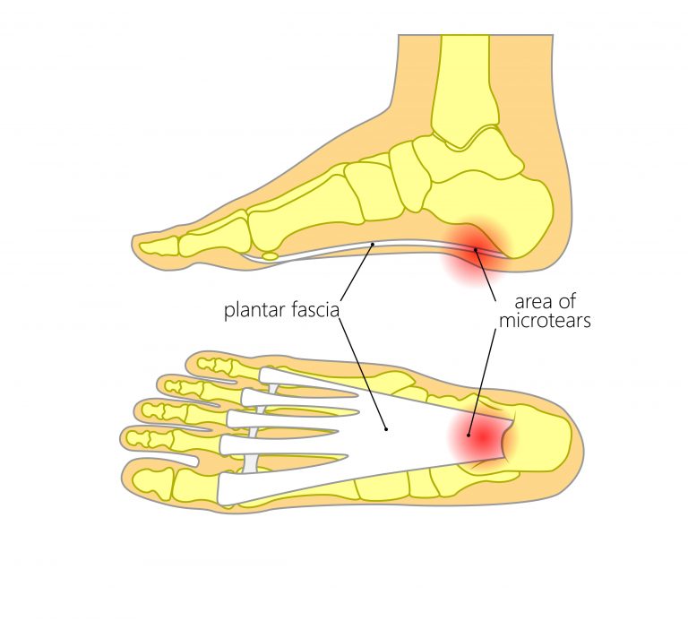 Plantar Fasciitis - My Family Physio