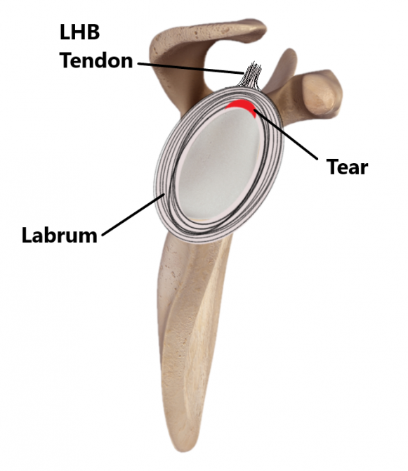 Biceps Tendon Injuries - My Family Physio