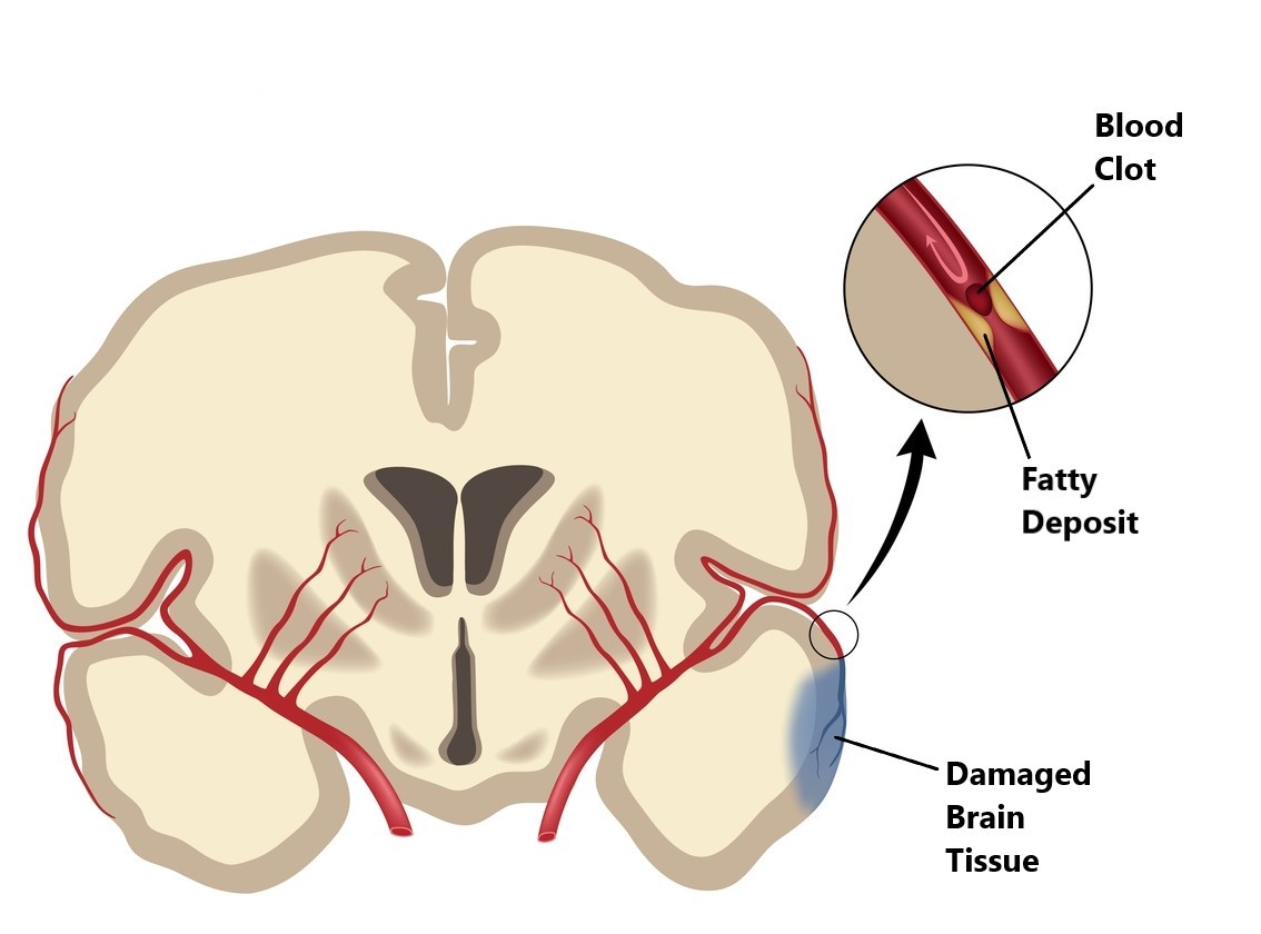Stroke - My Family Physio