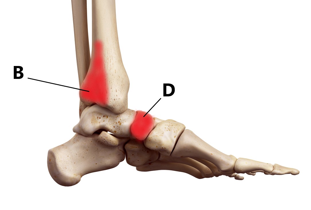 Ankle Sprains - My Family Physio