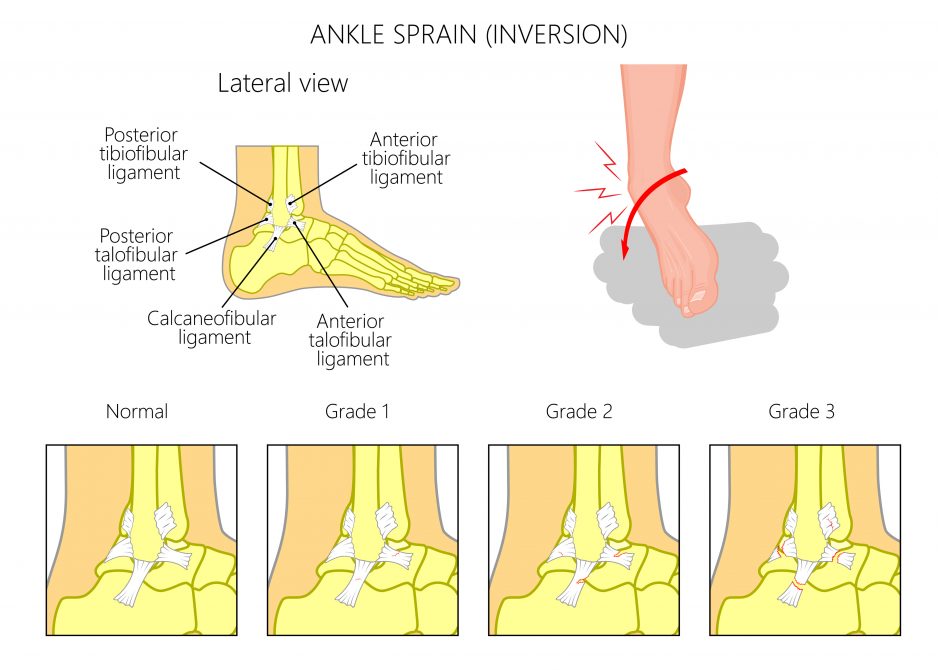 Ankle Sprains - My Family Physio