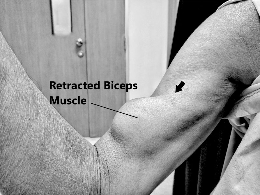 Biceps Tendon Injuries - My Family Physio