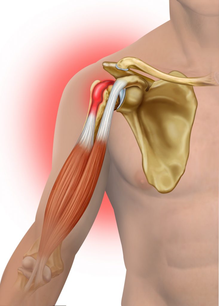 Biceps Tendon Injuries My Family Physio Biceps Tendon Injuries My Family Physio