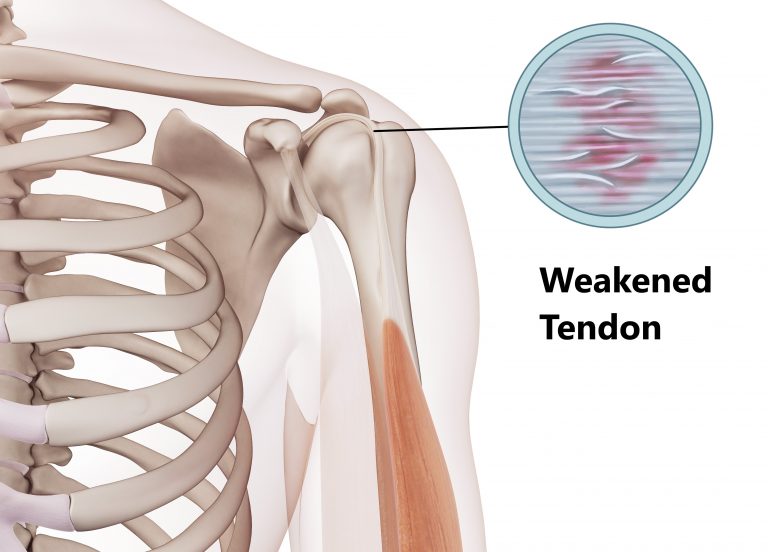 Biceps Tendon Injuries - My Family Physio
