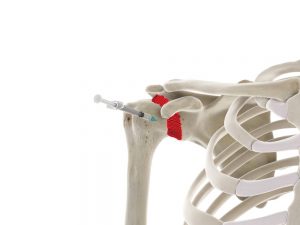 Frozen Shoulder - My Family Physio