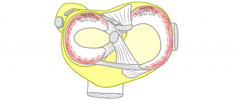 Meniscus Injuries - My Family Physio
