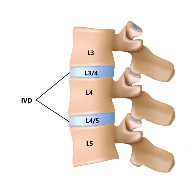 Modic Changes - My Family Physio