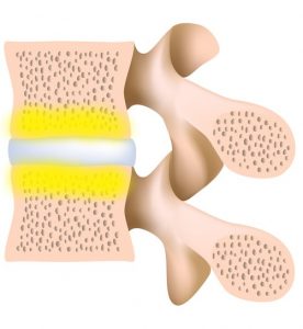 Modic Changes - My Family Physio