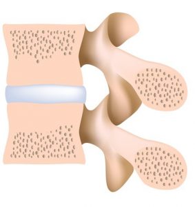 Modic Changes - My Family Physio