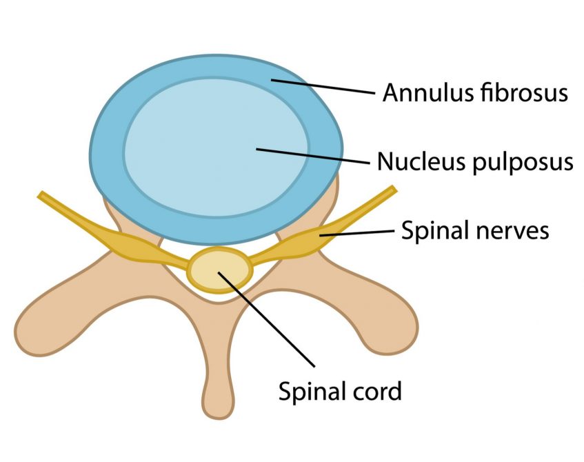 Intervertebral Disc Injuries - My Family Physio