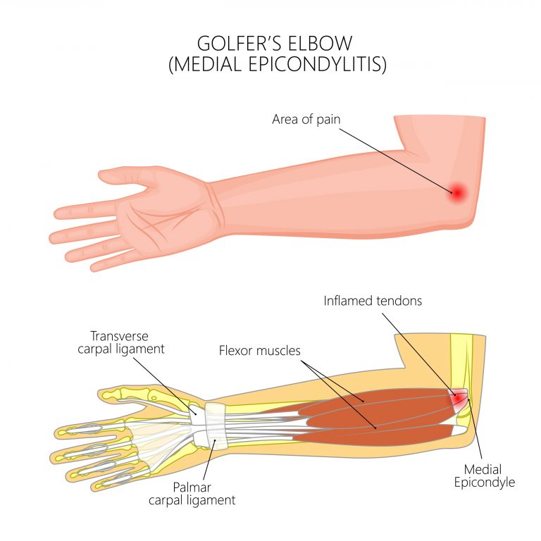 Common Elbow Injuries - My Family Physio
