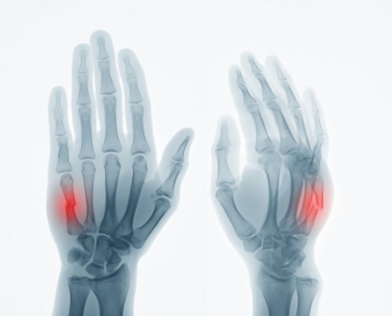 Common Hand Injuries - My Family Physio