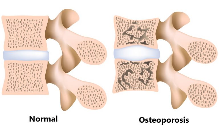 Common Lower Back Injuries - My Family Physio