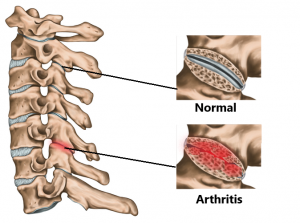 Common Neck Injuries - My Family Physio