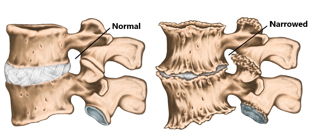 Facet Joint Injuries - My Family Physio