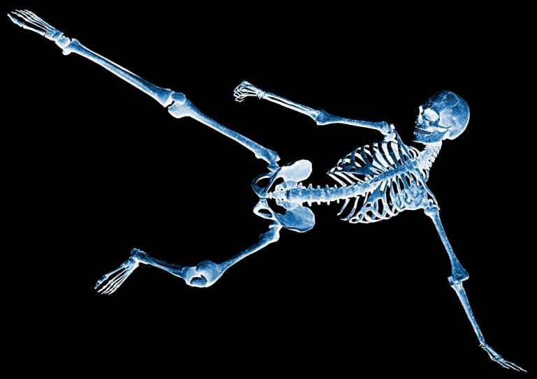 Osteoporosis - My Family Physio