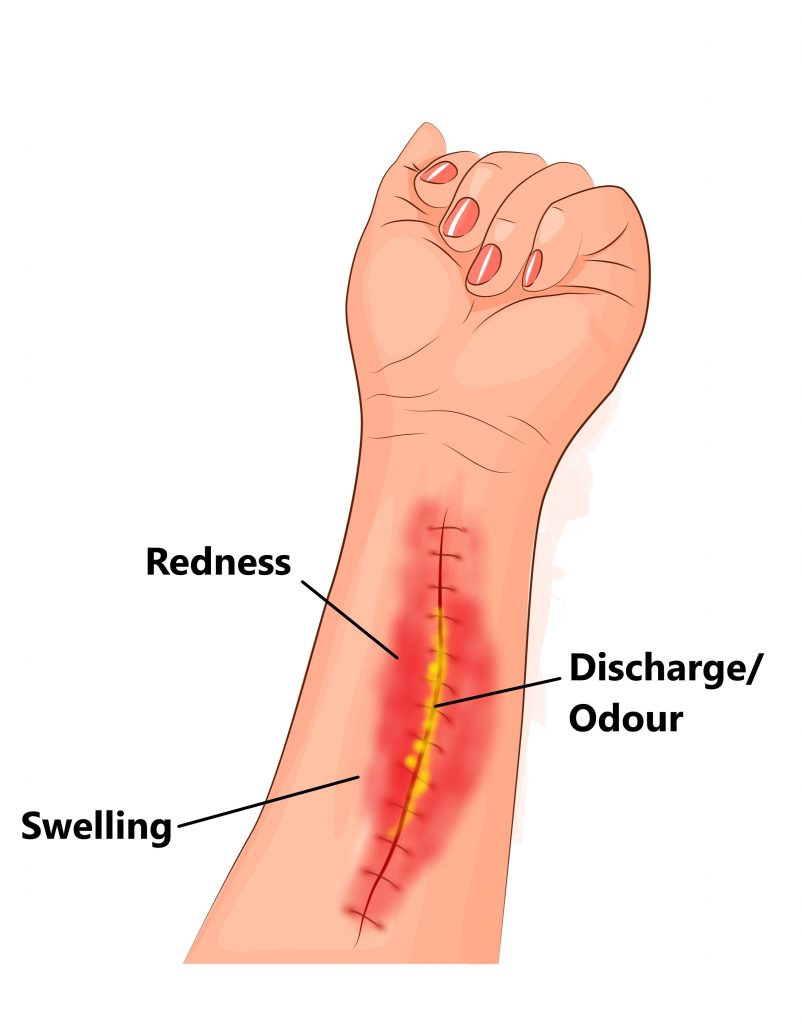 Post Operative Complications My Family Physio Post Operative Complications My Family Physio