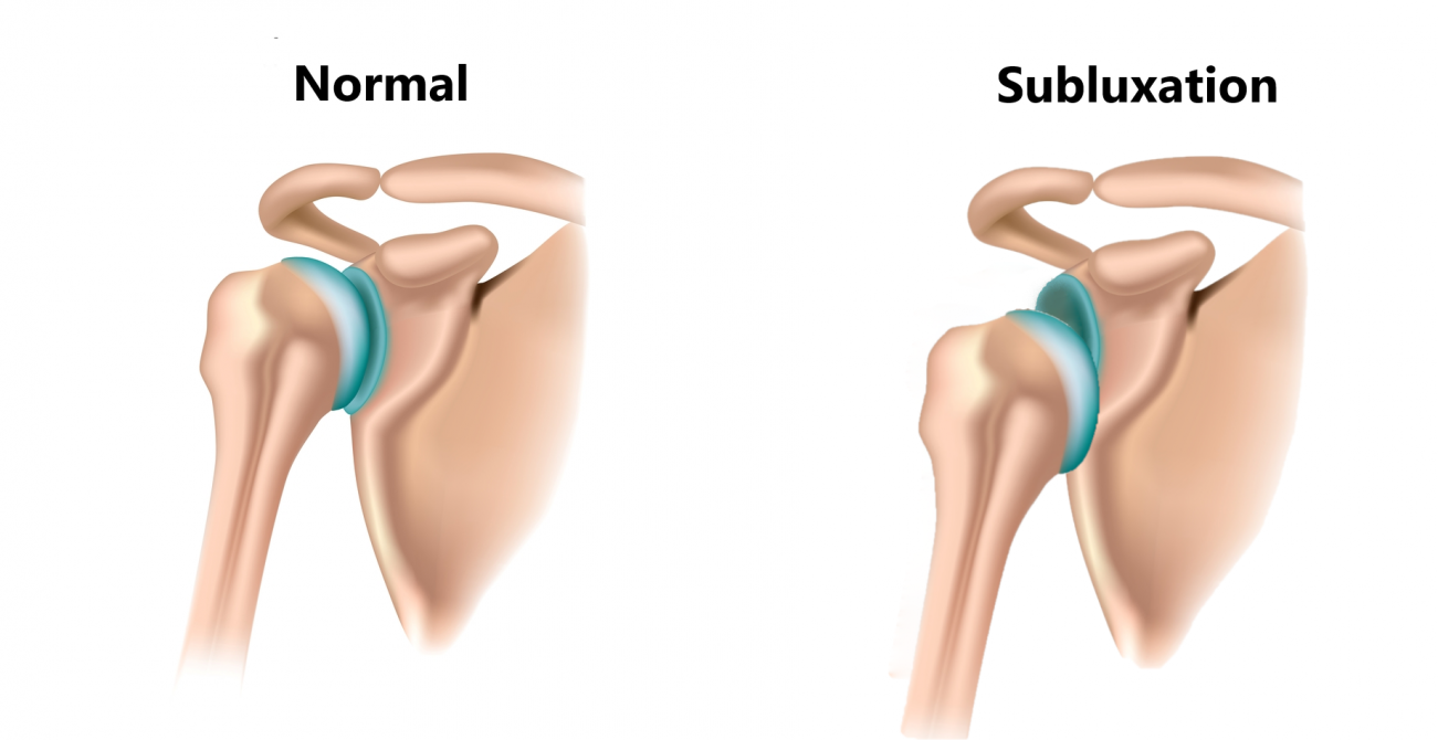 Shoulder Dislocations My Family Physio
